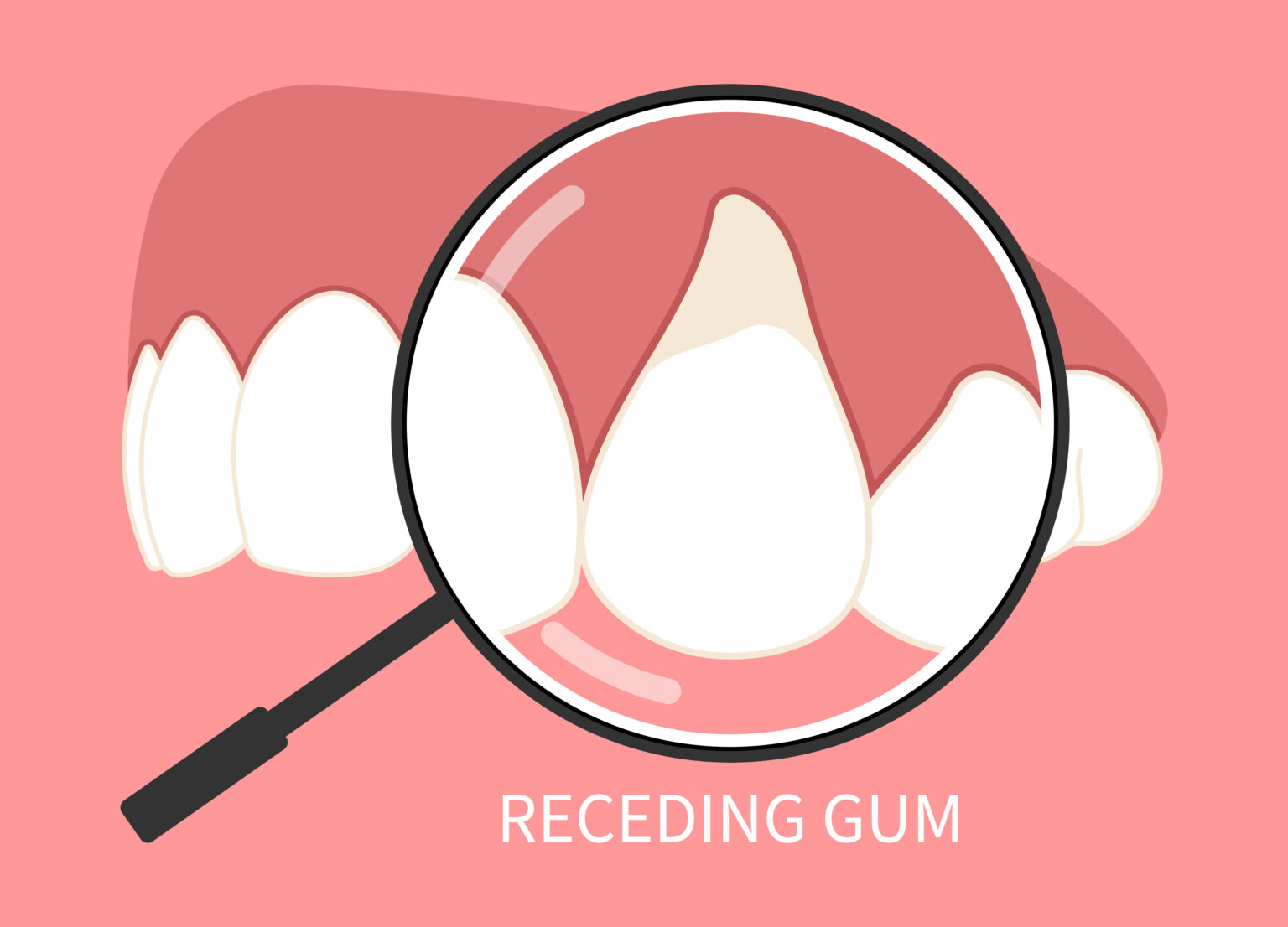 The Pinhole Gum Graft Alternative | Encinitas, CA