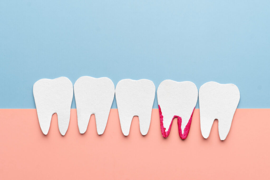 How Periodontal Disease Causes Tooth Loss | Encinitas, CA