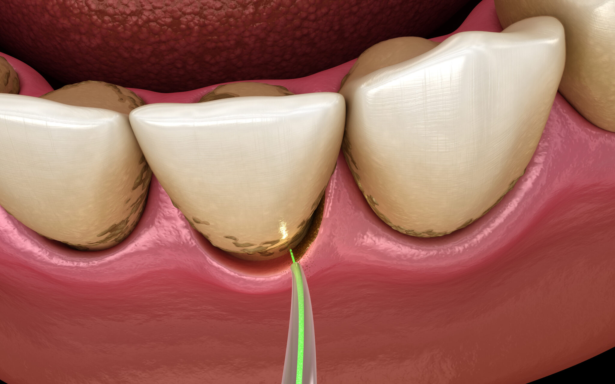 Laser-Assisted Treatment For Gum Disease | Encinitas, CA