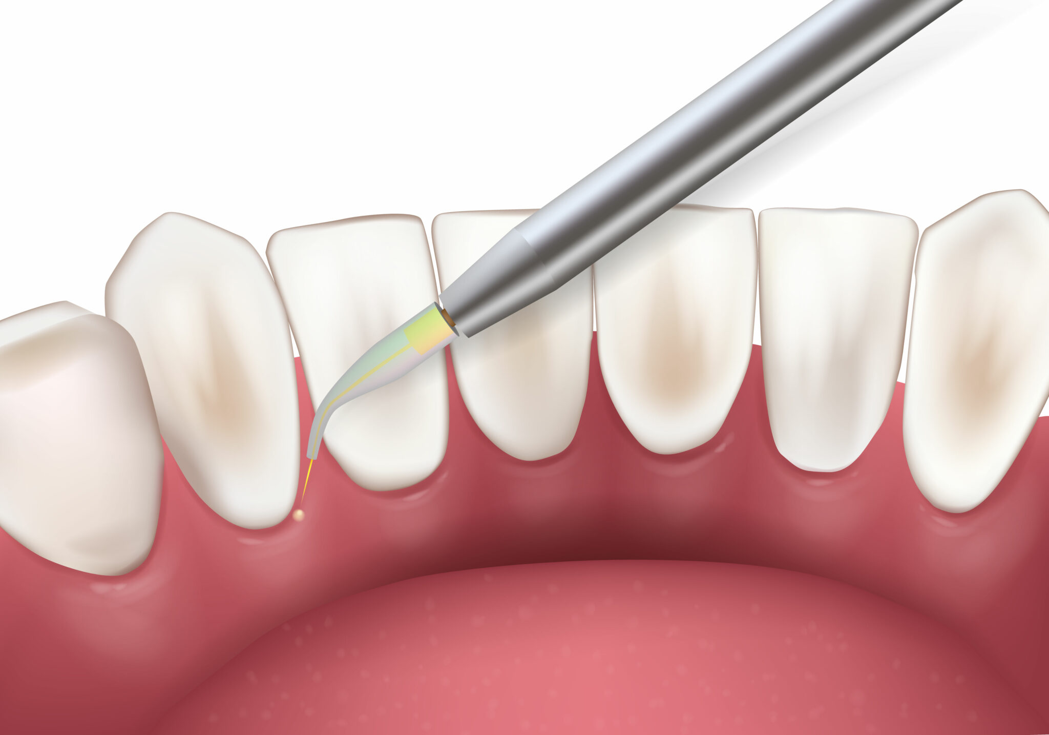How Lasers Assist With Your Gum Treatments | Encinitas, CA