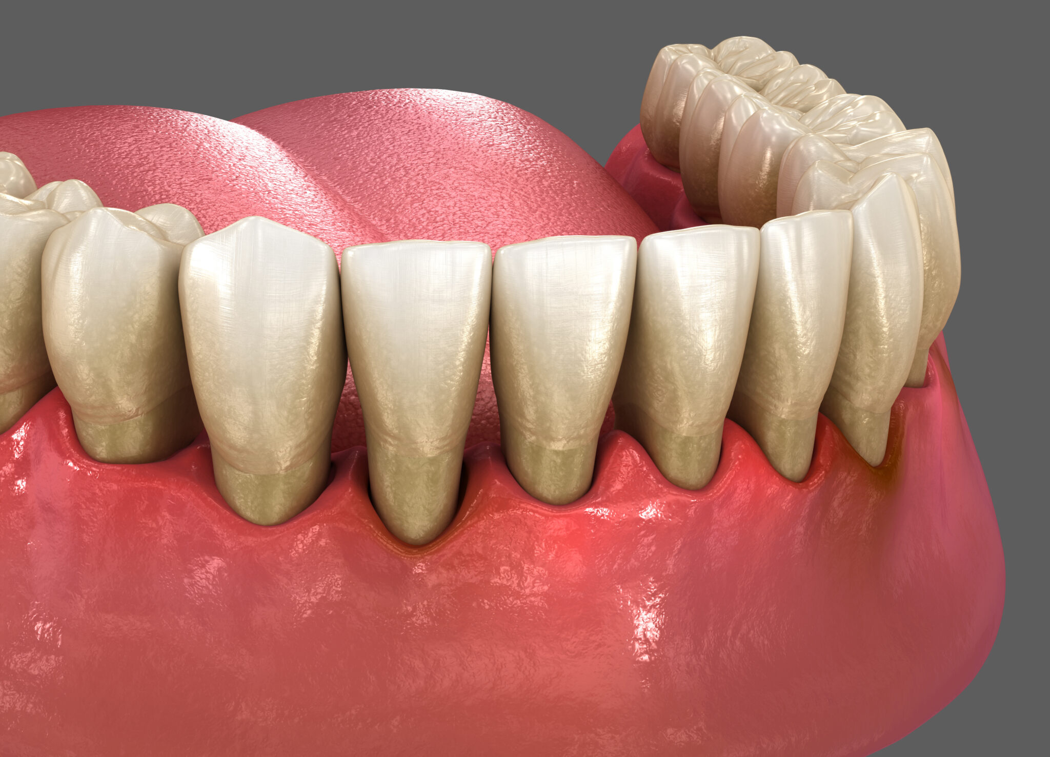 Repairing Recession With Pinhole Gum Grafts | Encinitas, CA