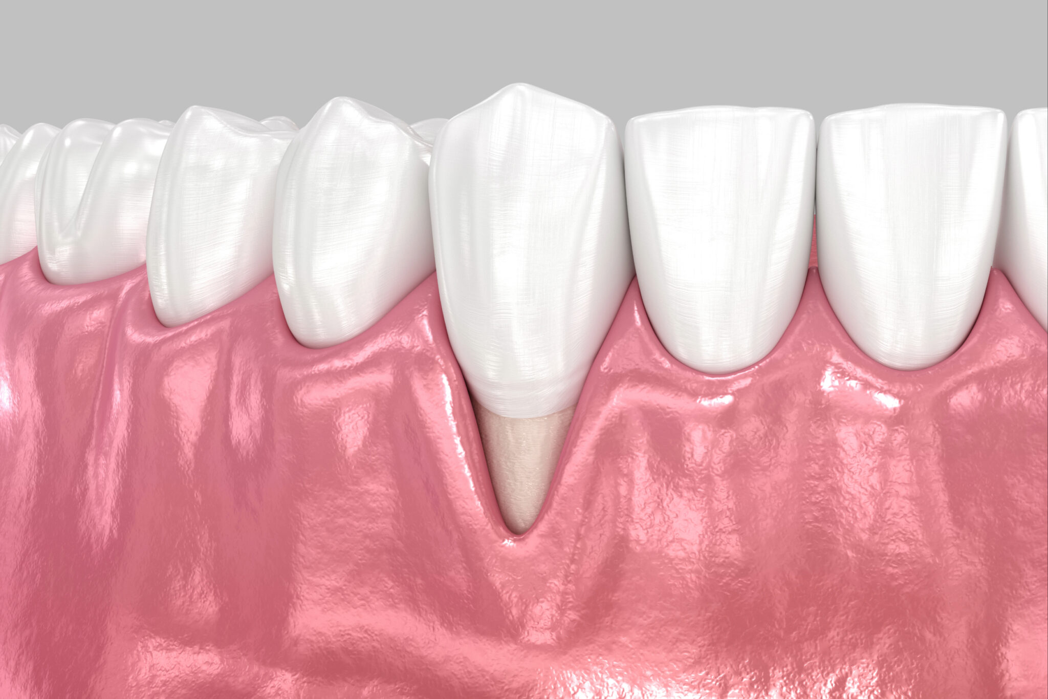 Pinhole Gum Grafts Treat Recession | Encinitas, CA